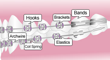Beim Orthodontics Blog: Parts of Braces