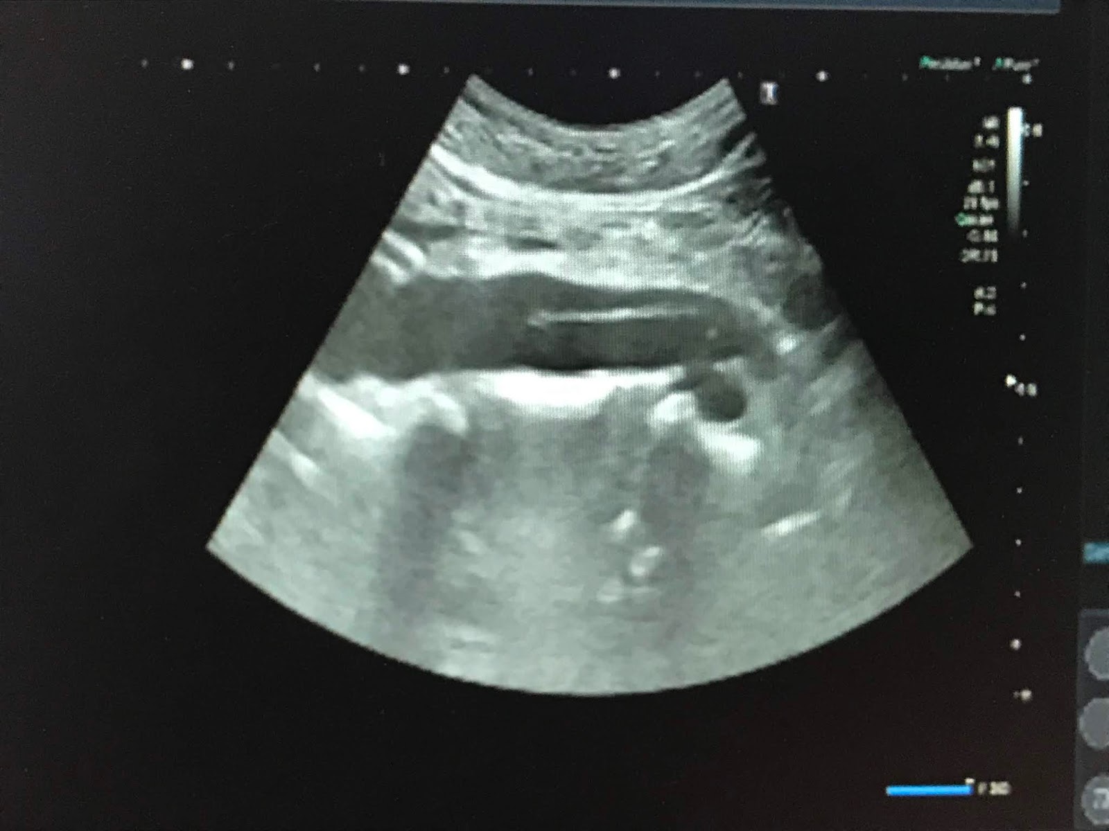 Aortic Dissection Ultrasound