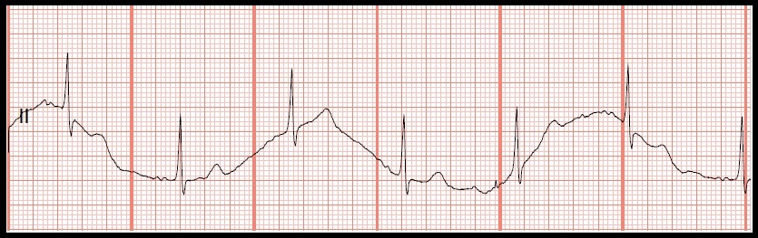Practice EKG Rhythm Strips 161