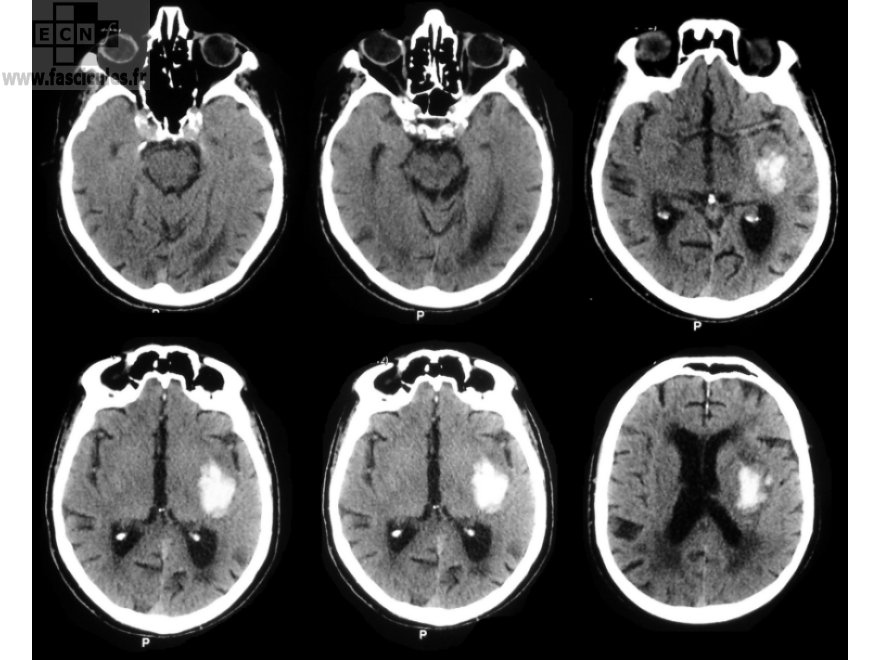 Les accidents vasculaires cérébraux