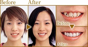 Yusuke Japan Blog: Japanese Teeth alignment is not good