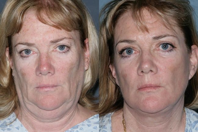 Cheek Exercises And Face Workouts For Reducing Chubby And Sagging Cheeks