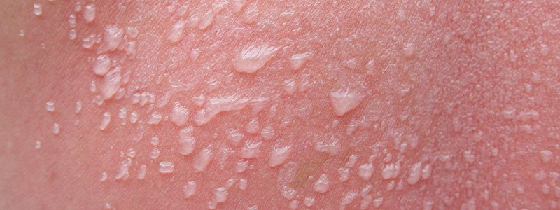 Qu'est-ce que le zona? À quoi ressemble le zona?