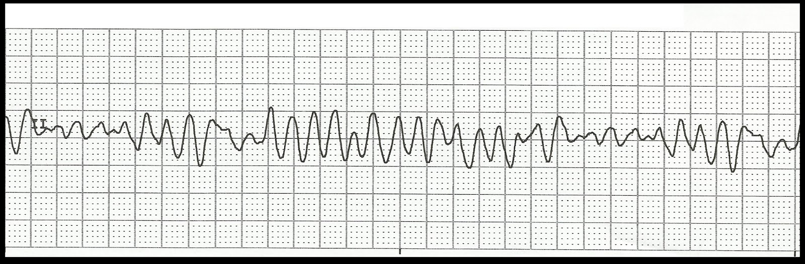 Practice EKG Rhythm Strips 177