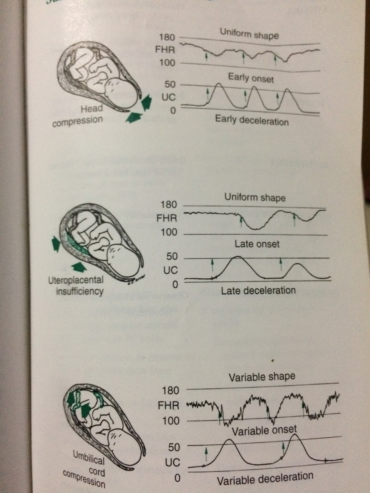 CTG ( CardioTocoGrafi) ~ info up date bidan
