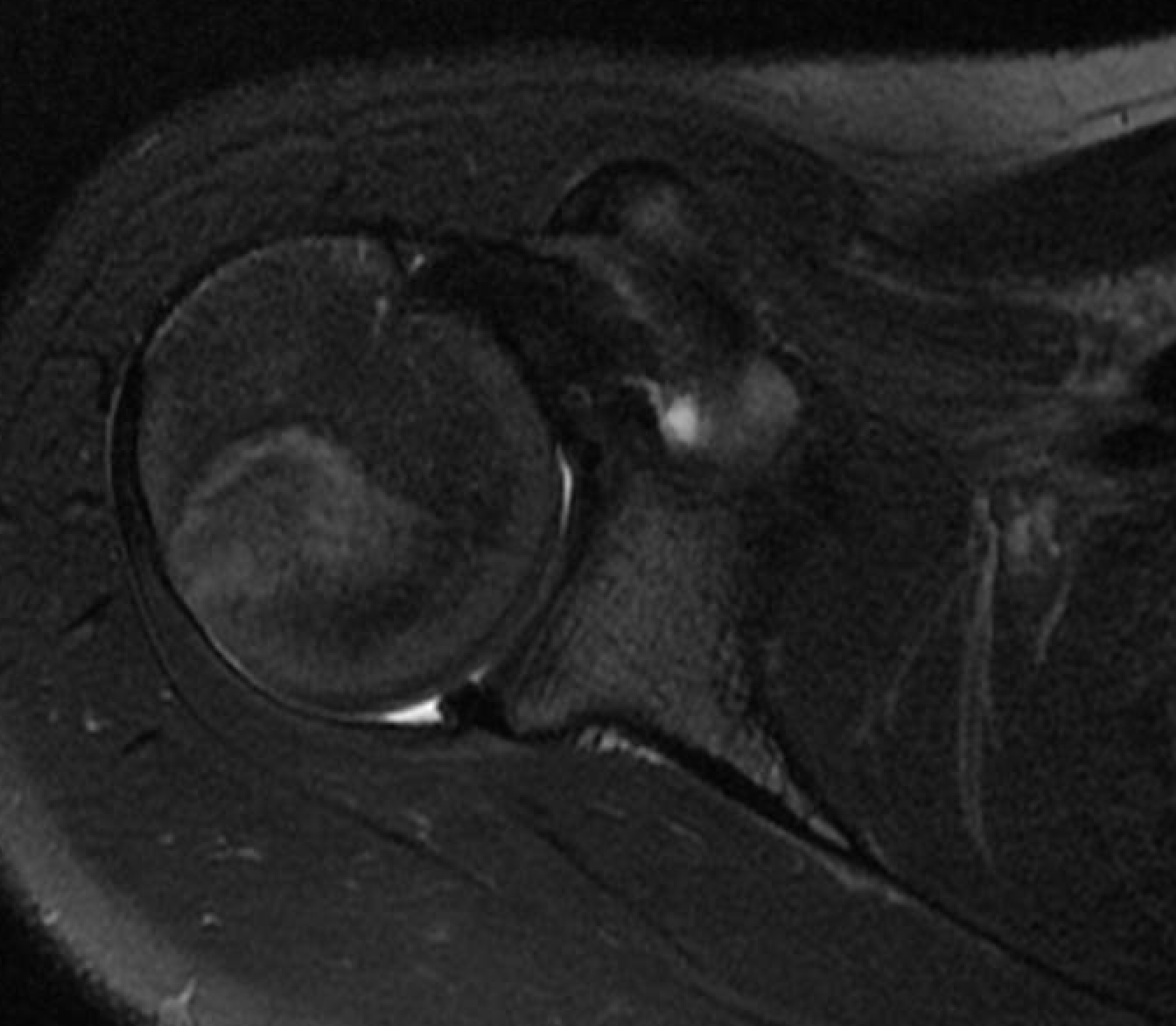 Shoulder and Elbow Surgery: Posterior chondrolabral cleft and recurrent ...