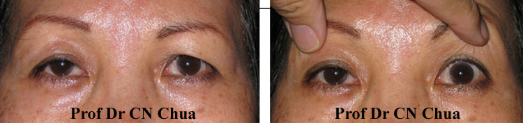 Eyelid Surgery by Prof Dr CN CHUA 蔡鐘能: Unequal Double Eyelids (skin ...