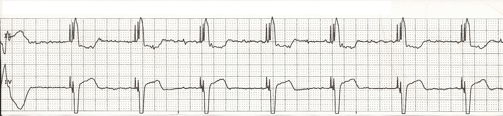 Float Nurse: EKG Rhythm Strips 65
