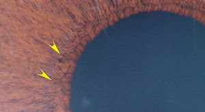 Modern & Multidimensional Iridology: Ulnar & Radial Loop