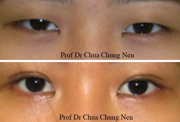 Eyelid Surgery by Prof Dr CN CHUA 蔡鐘能: Doc, Can You Perform Suture ...