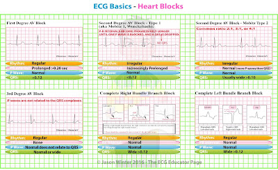 ECG Educator Blog : Heart Blocks