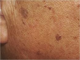 HAIRFACECLINIC: PEMBUANGAN TOMPOK TOMPOK HITAM (LENTIGINES)