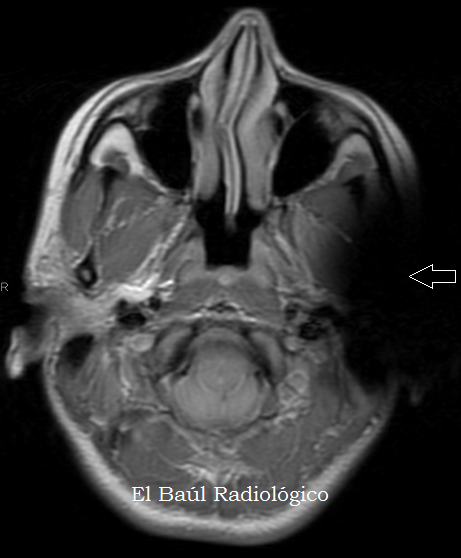 El Baúl Radiológico: ARTEFACTOS EN IRM ( More artifacts in MRI) by luis ...
