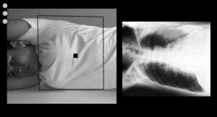 Tórax- Decubito Lateral