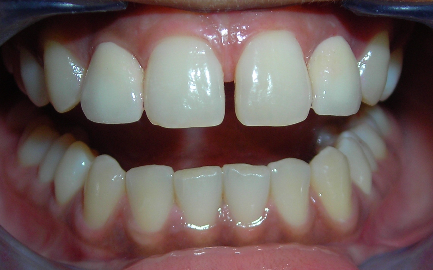 Restorative Dentistry & Endodontics: Pegged for Crown