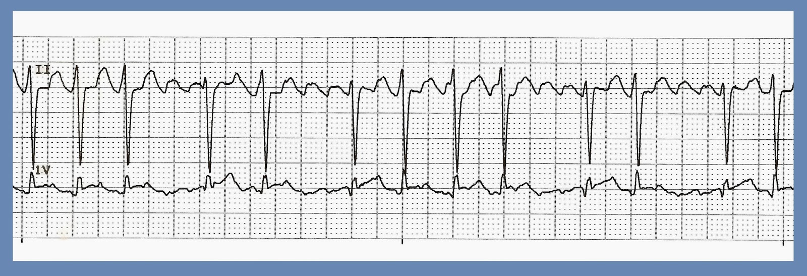 Ecg Atrial Flutter With Rapid Ventricular Response And Right Bundle Images