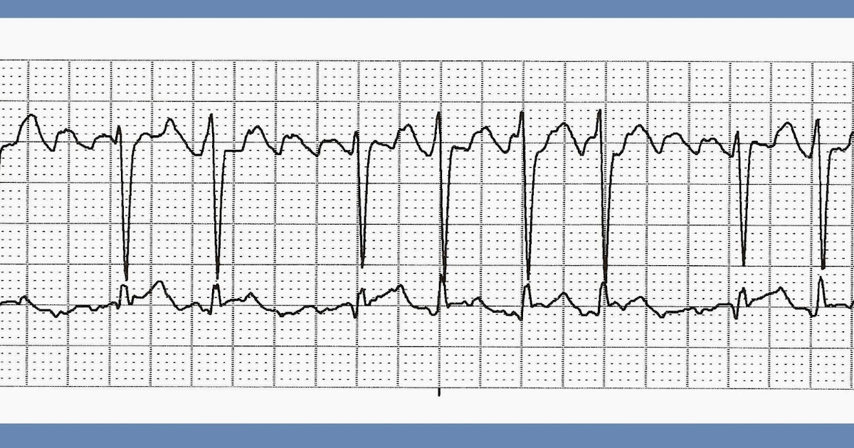 Float Nurse: Practice Rhythm Strips 290