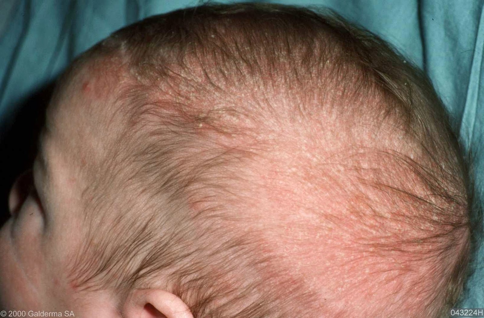 SKIN DISEASE TYPES: Seborrheic Dermatitis