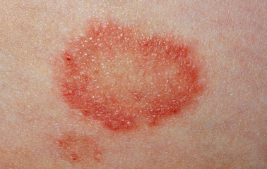 PEMERIKSAAN KULIT, RAMBUT, DAN KUKU ~ Nurse