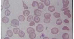 FICHERO HEMATOLOGIA : Codocito