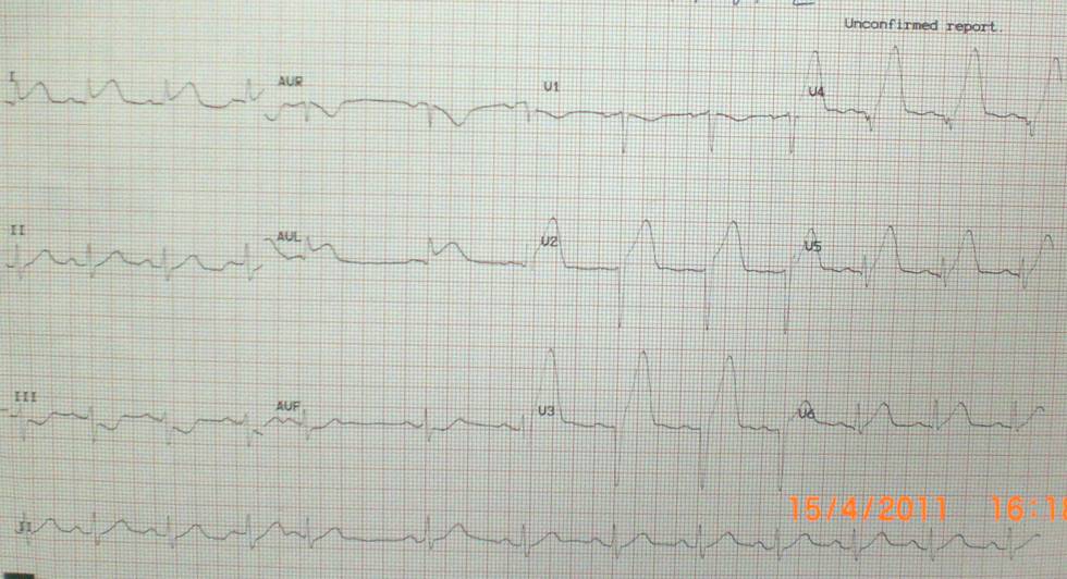 Phimaimedicine: 1,096. Antero-lateral wall myocardial infarction