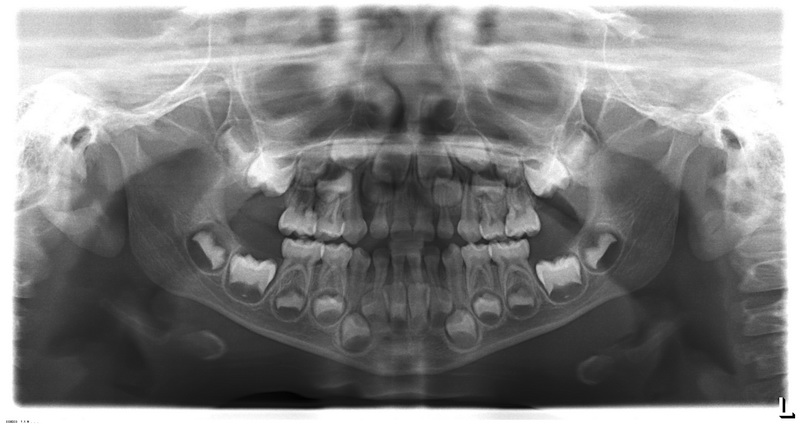 Salud dental, salud global.: La dentición en los niños