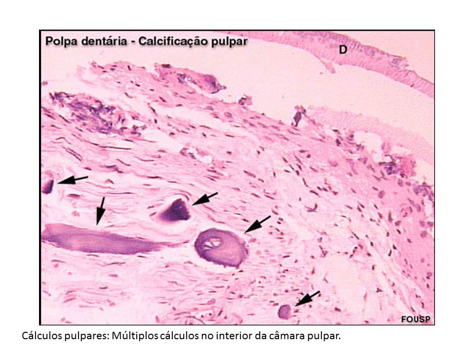 Patologia Oral : Calcificações Pulpares