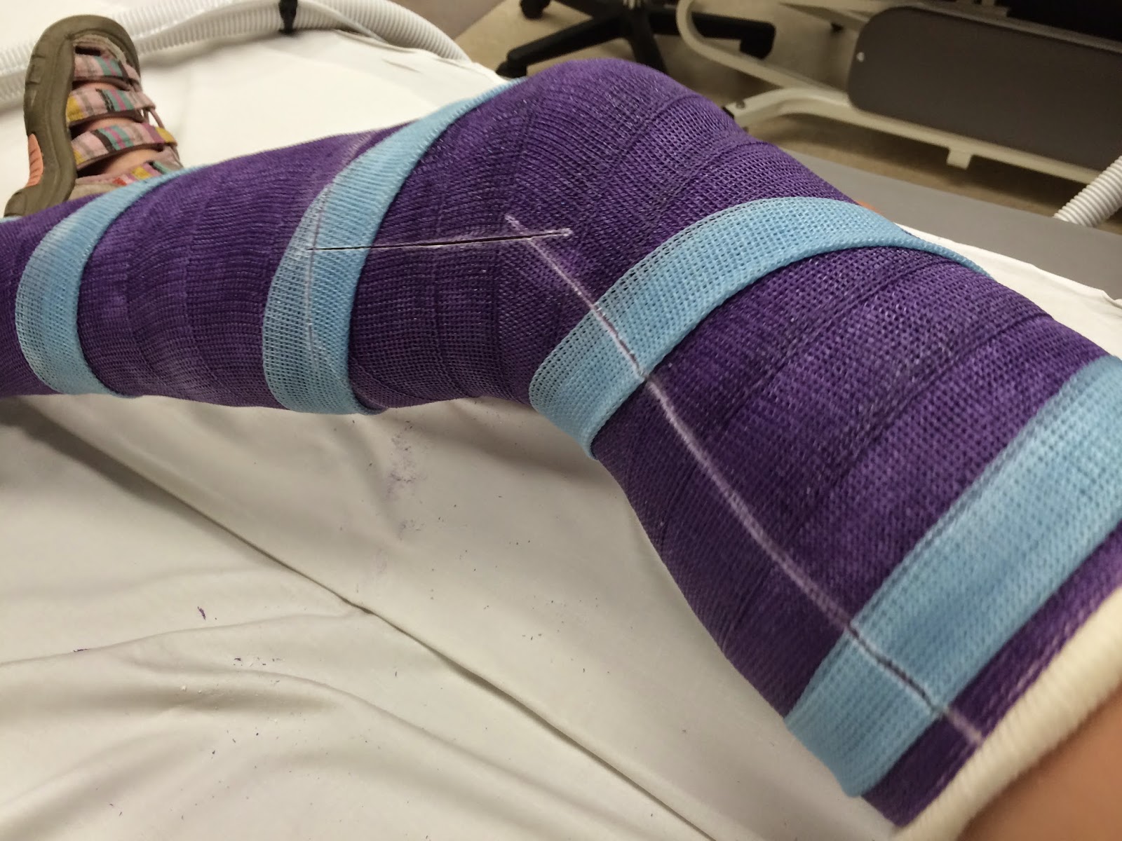 fibular hemimelia leg lengthening: Post-Op Appt.