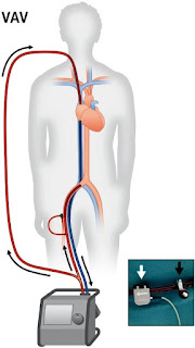 ER goldbook: ECMO (5/6): Hybrid circuit, weaning, decannulation