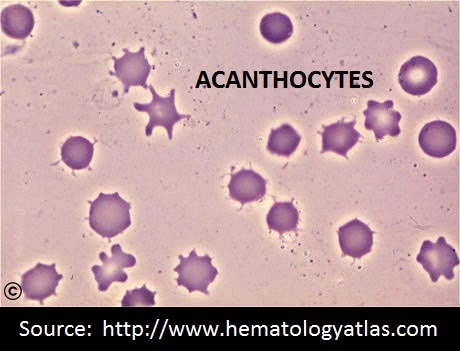 Lab Atlas: Acanthocytes
