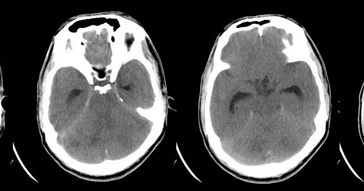 Dr Balaji Anvekar Frcr Subdural Empyema
