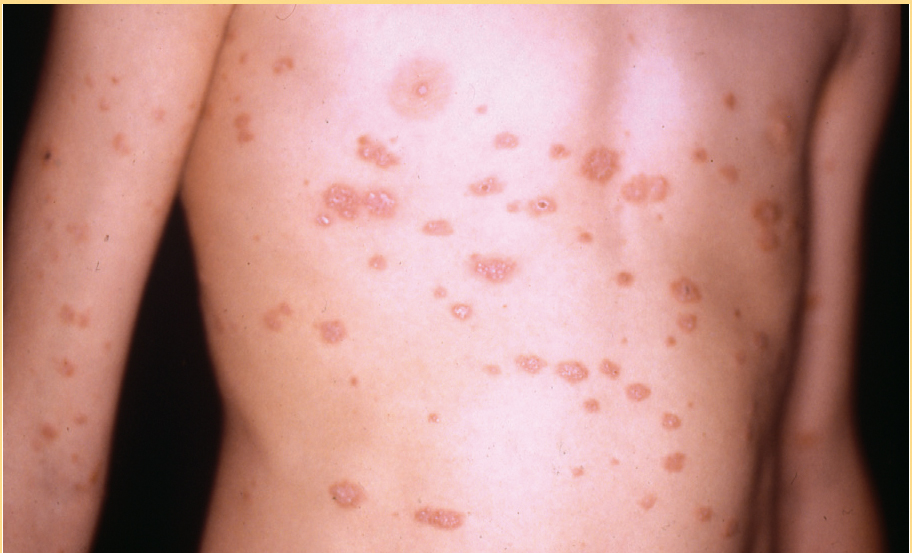 Tipos de Psoriasis | ¿Cuales son los Tipos de Psoriasis?!