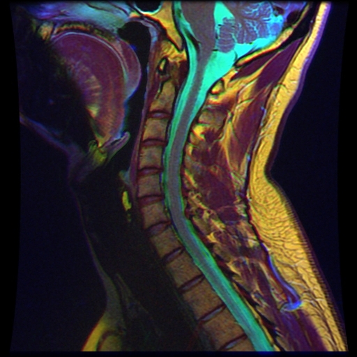 Nevit's blog: Color MRI of Cervical vertebrae