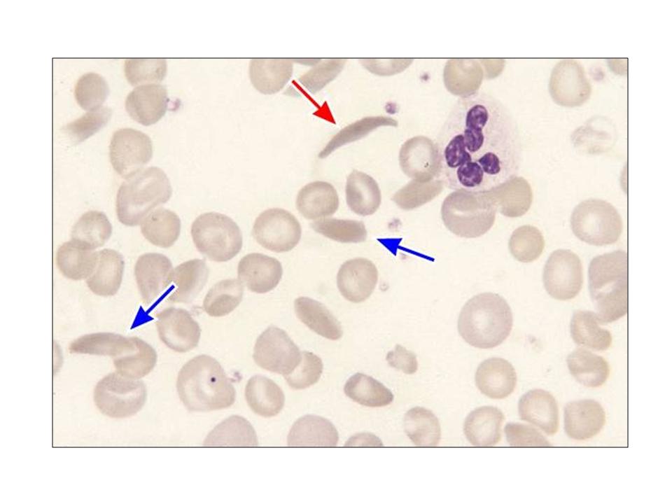 SÍNDROME ANÉMICO: ANEMIA DE CÉLULAS FALCIFORMES
