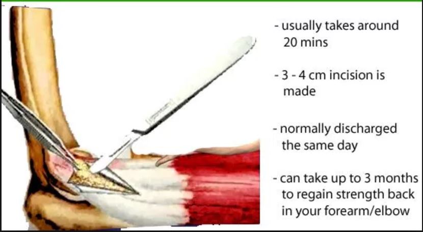 Tennis Elbow and Golfers Elbow Symptoms, Treatment and Surgery ...