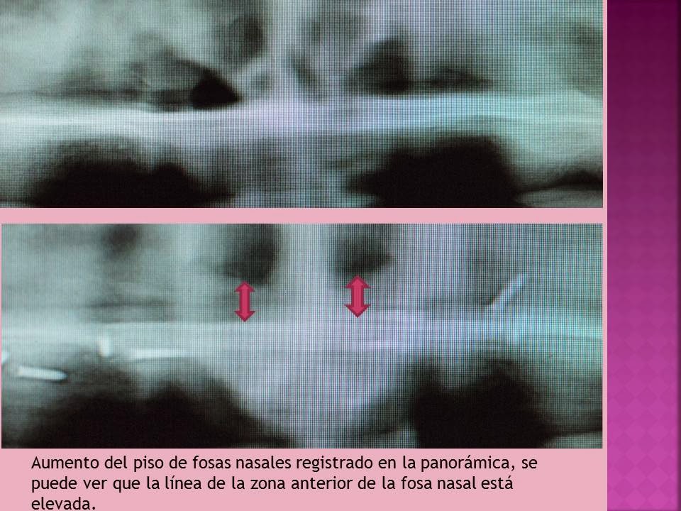 Escuela Implantológica Campos Clinicae: Injerto en Bloque Autólogo