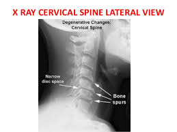 What Is Cervical Spondylosis? | Treatments And Symptoms ...
