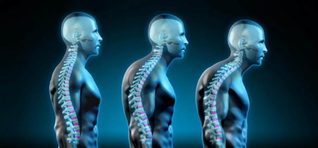 9 how simple and easy , most potent Treat Crooked Spine (Scoliosis or ...