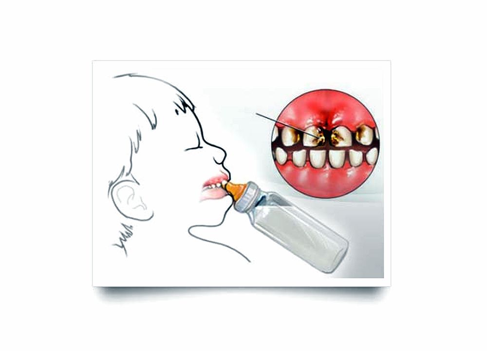 CARIES DE BIBERÓN o Caries de la Infancia Temprana (CIT) : Como ...