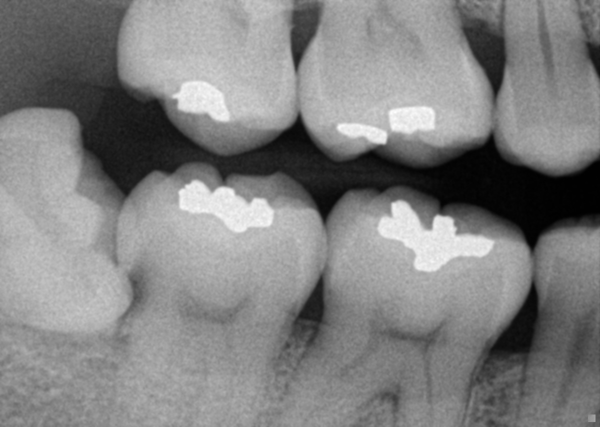 sweet tooth: distal decay on 2nd molars.
