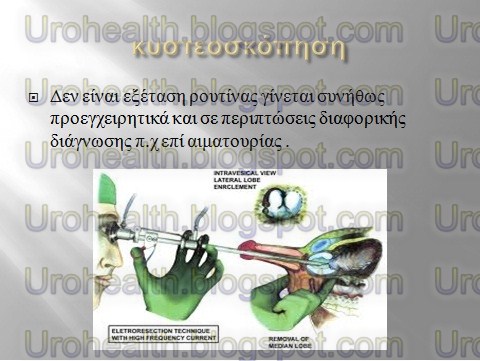 ΛΟΥΤΣΑΡΗΣ ΚΩΝΣΤΑΝΤΙΝΟΣ ΧΕΙΡΟΥΡΓΟΣ ΟΥΡΟΛΟΓΟΣ: ΥΠΕΡΤΡΟΦΙΑ ΤΟΥ ΠΡΟΣΤΑΤΗ