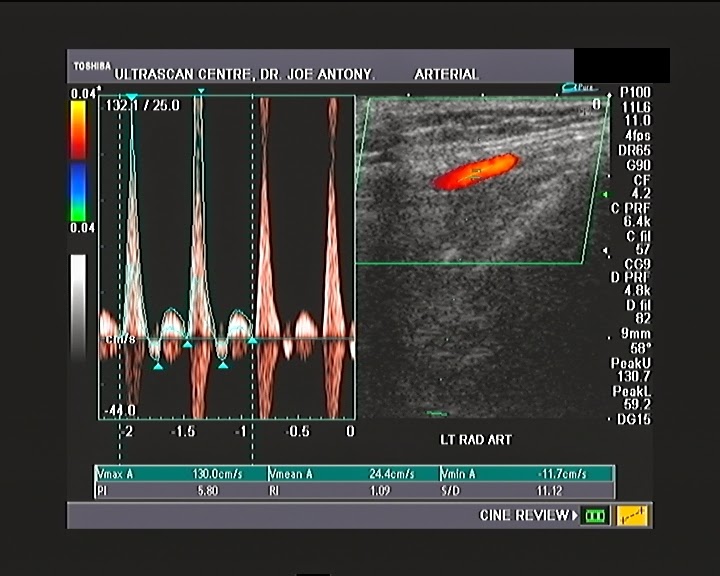A patient of subclavian arterial bruit ~ Ultrasound Cases Info