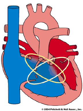 CAVSD | Complete Atrioventricular Septal Defect ~ Cardiovascular Nurse