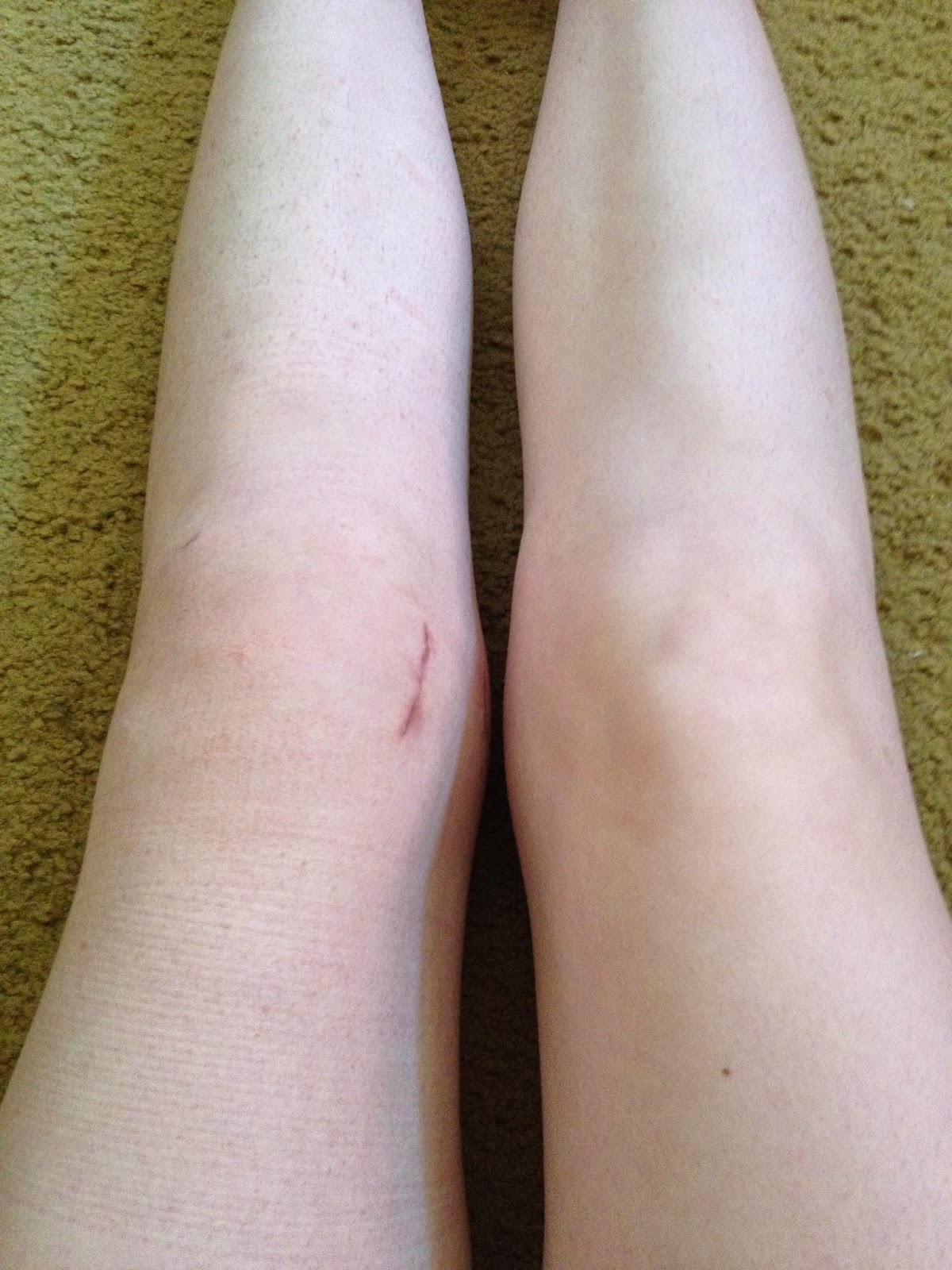 One Step Forward, Two Steps Back- My MPFL Reconstruction Story