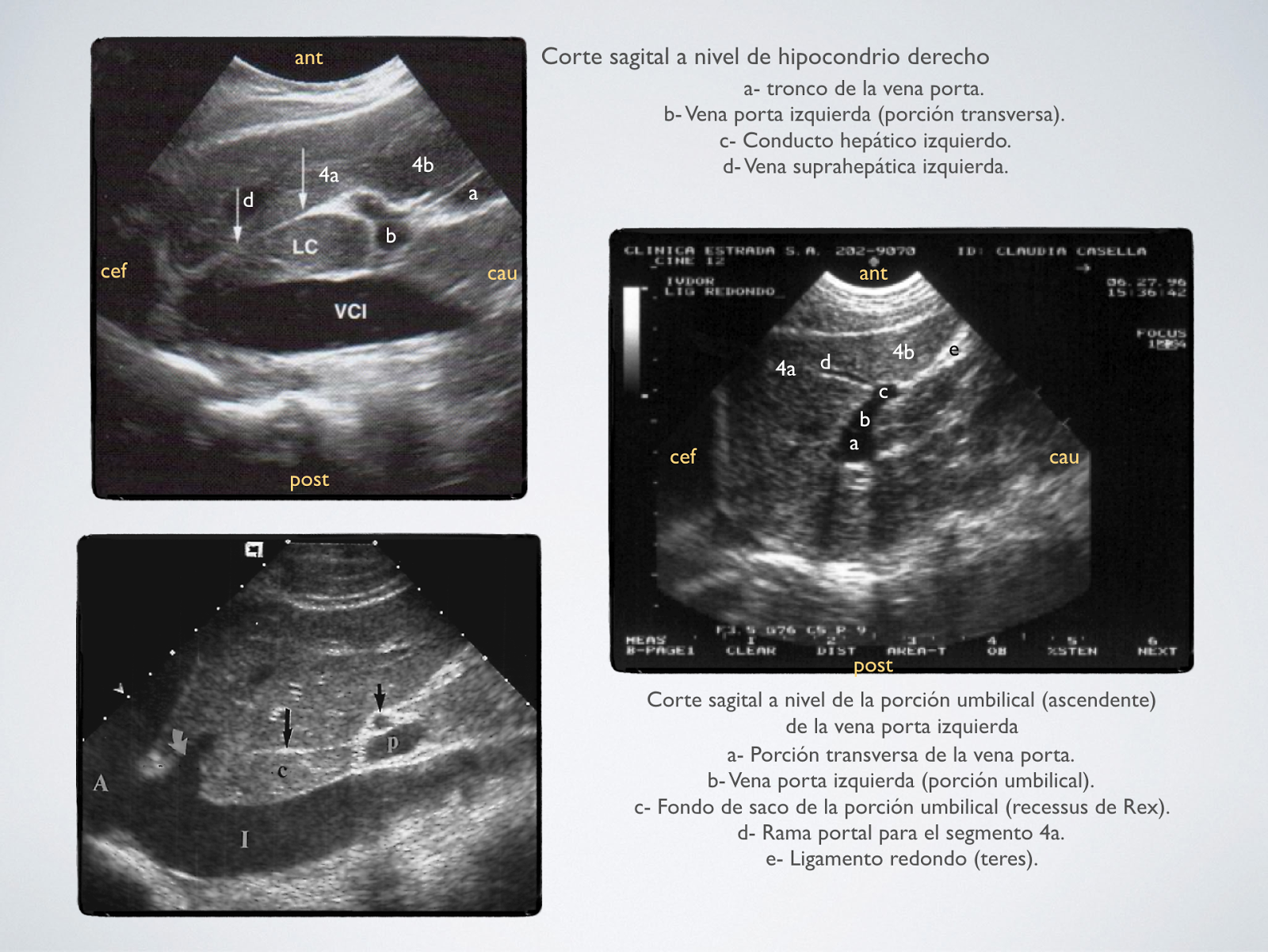 Cuadernos de Anatomía Quirúrgica: Segmentación hepática en ecografía.