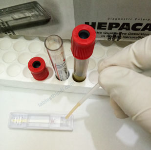 HBsAg Test कैसे करते है ~ Lab Test Hindi