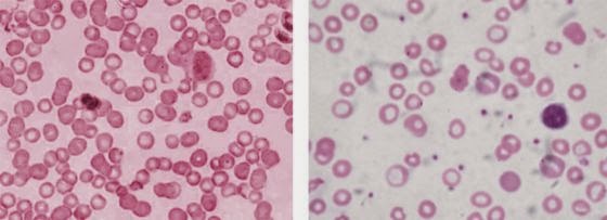 HEMATOLOGIA: ANEMIAS NORMOCITICAS
