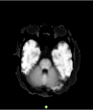 pediatric neurology: The consequence of a reversal sign