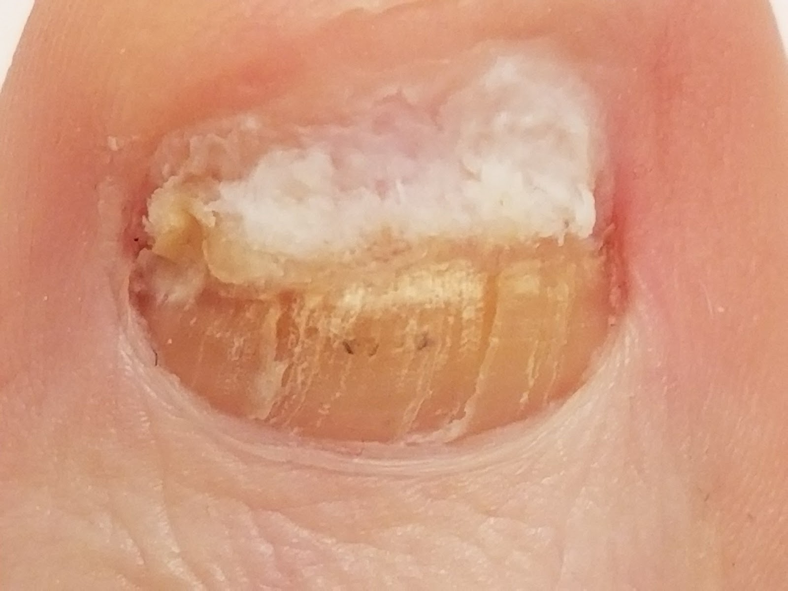 Run with Perseverance: A Tale of Two Toenails; How to Fix Runner's Toenails