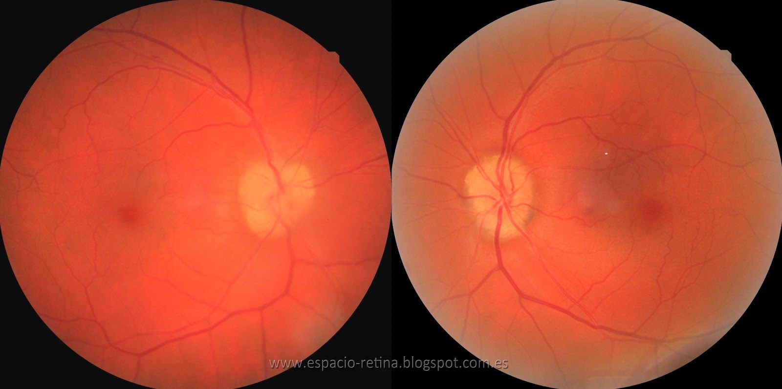 ESPACIO RETINA: Drusas en el nervio óptico.